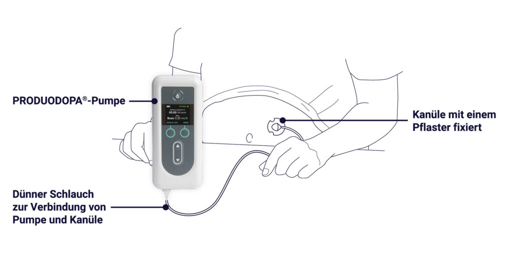 PRODUODOPA® bei der Parkinson-Krankheit
